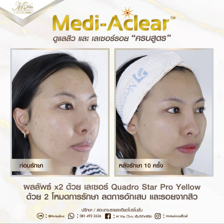 รู้จัก Dual Yellow Laser คืออะไร? ดีไหม? ทำกี่ครั้งเห็นผล?