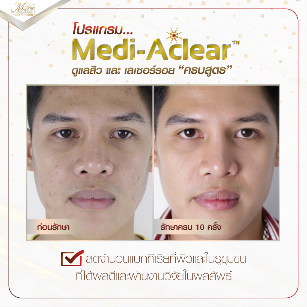 รู้จัก Dual Yellow Laser คืออะไร? ดีไหม? ทำกี่ครั้งเห็นผล?