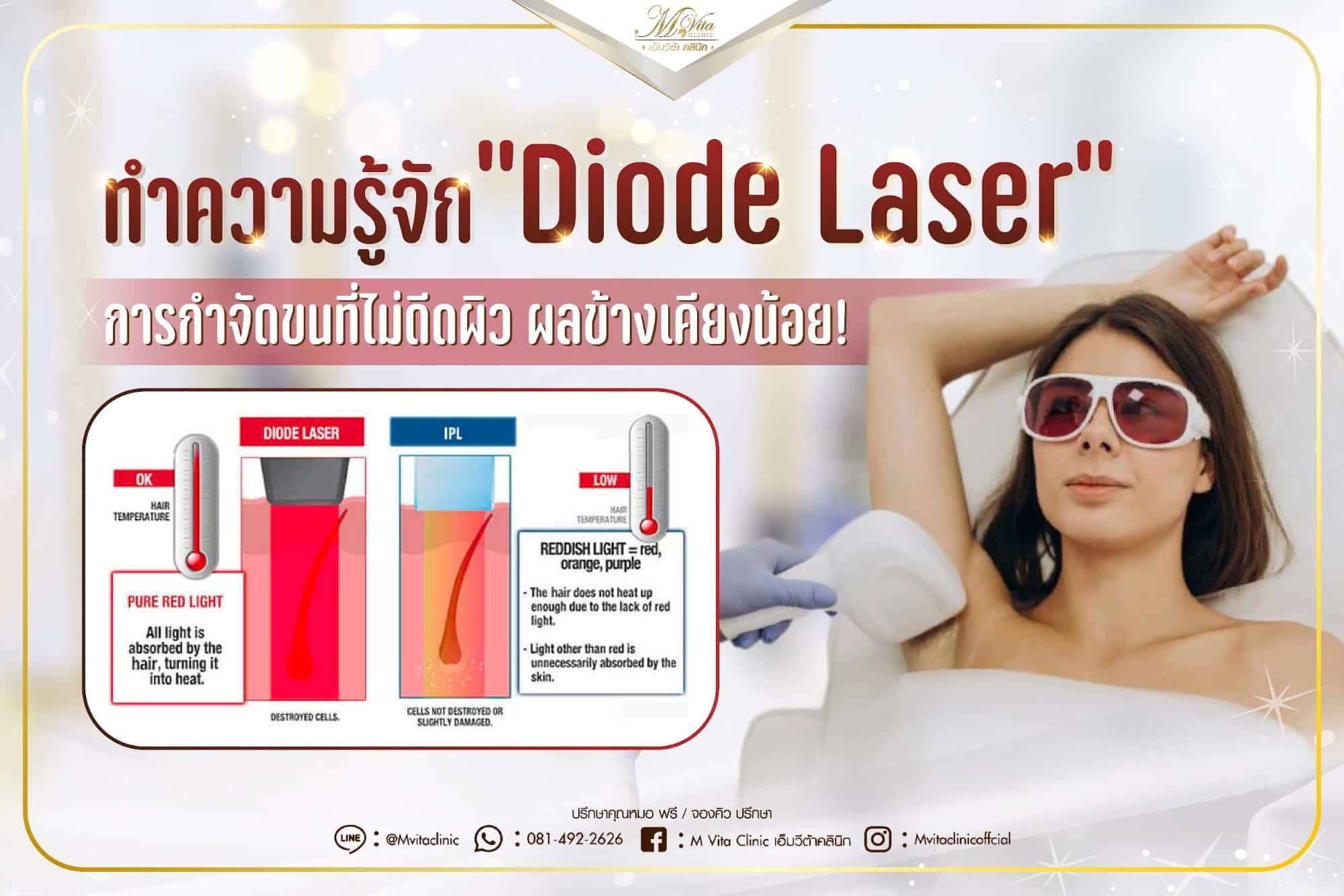 กำจัดขนด้วย Diode Laser ไม่เจ็บ ไม่เสี่ยงเป็นแผลเป็น!