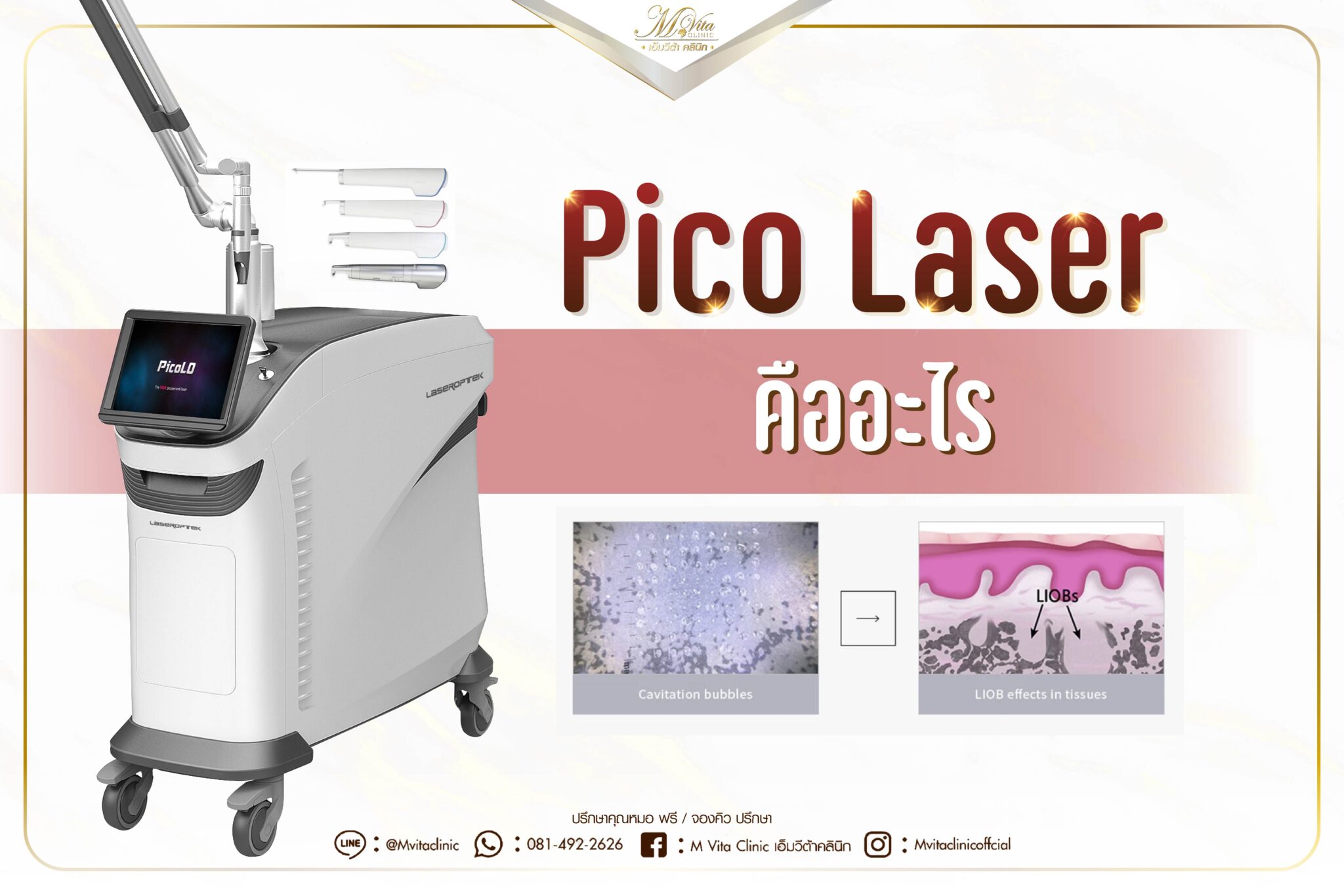 Pico Laser รีวิว ราคาเท่าไหร่ ? ที่ไหนดี ? คืออะไร ? ดีจริงไหม