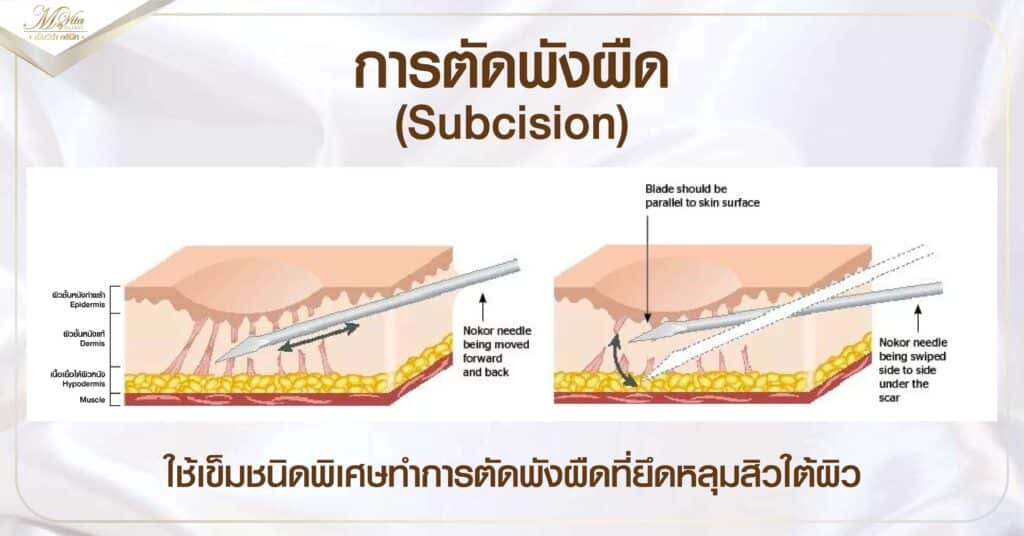 หน้าเป็นหลุมสิวแก้ยังไง วิธีรักษาหลุมสิวที่ดีที่สุด หายเกลี้ยงเพียงทำตาม!