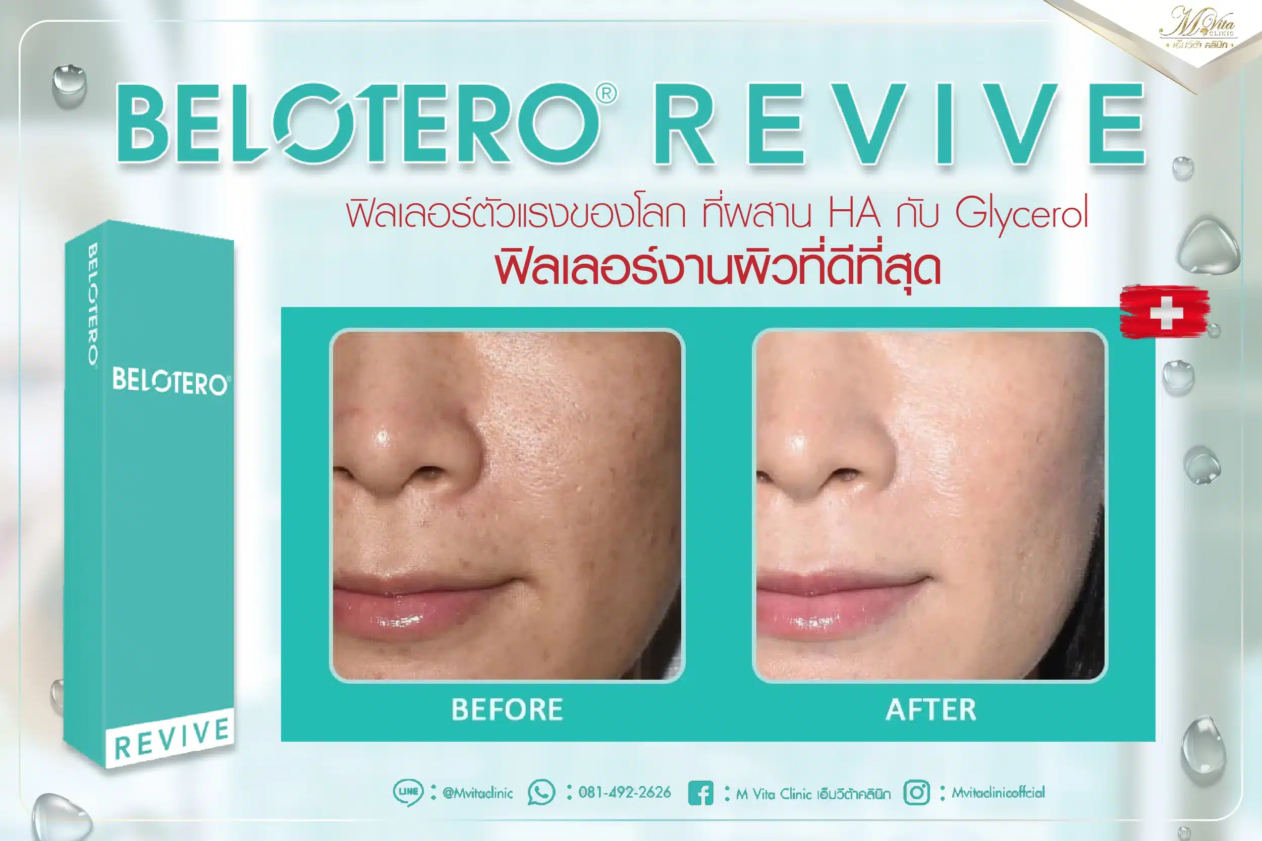 Belotero Revive คืออะไร ต่างจากฟิลเลอร์รุ่นอื่นอย่างไร พร้อมรีวิว