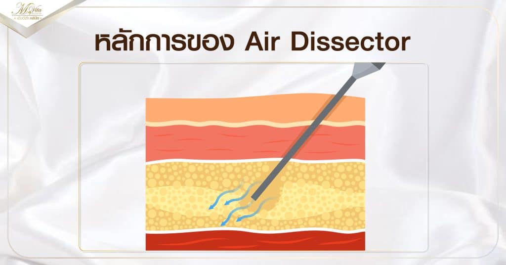 Air Dissector คืออะไร ตัดผังผืดด้วยแรงดันอากาศดีหรือไม่