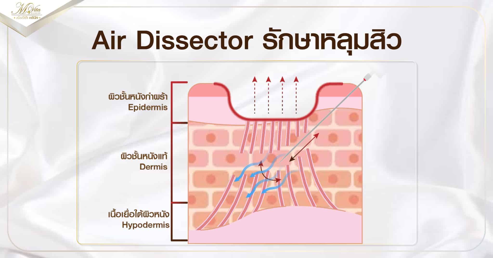 หลุมสิว เกิดจากอะไร มีกี่แบบ รักษาวิธีไหนดี ป้องกันอย่างไร
